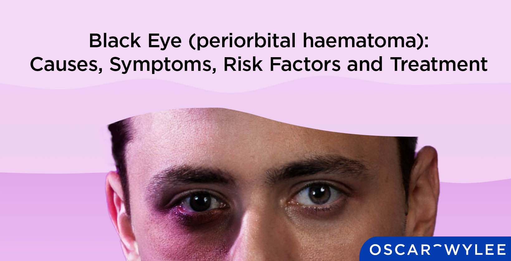 Black Eye periorbital Haematoma Causes Symptoms Risk Factor And