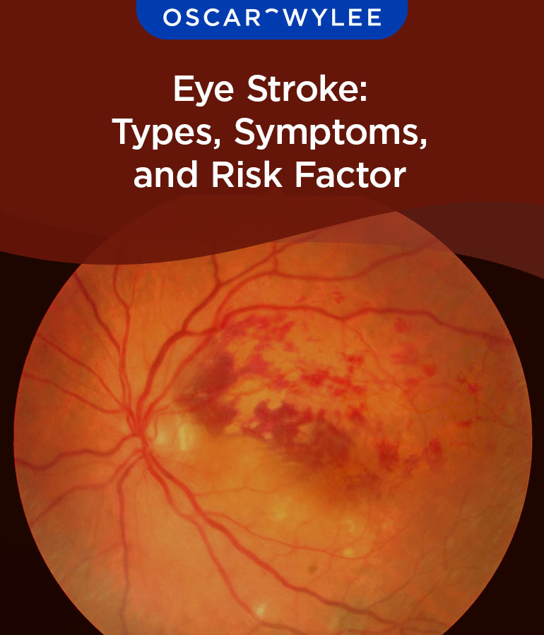 Eye Stroke Types Symptoms And Risk Factors